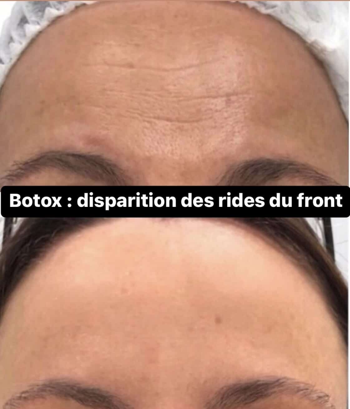 Injection de botox à Bordeaux | Dr Aurélien Rousvoal