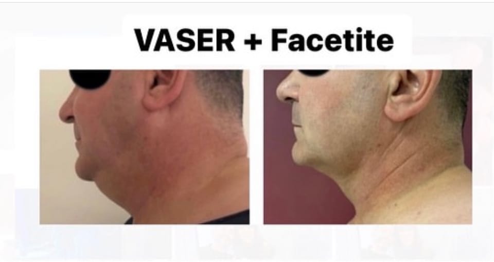 Lifting facial et lifting du cou pour homme à Bordeaux | Dr Rousvoal